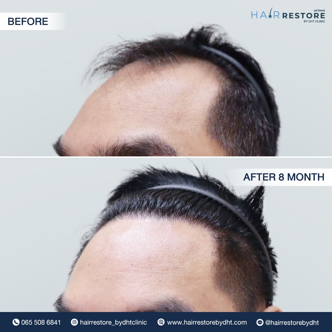 Hair Restore by DHT Clinic